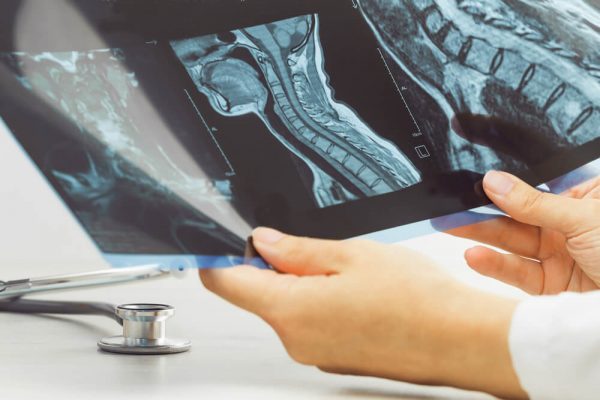 Pain Management Treatments for Acute Compression Fractures - Advanced ...