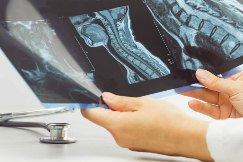 Pain Management Treatments for Acute Compression Fractures - Advanced ...